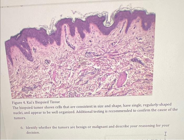 Solved Figure 4. Kai's Biopsied Tissue The biopsied tumor | Chegg.com