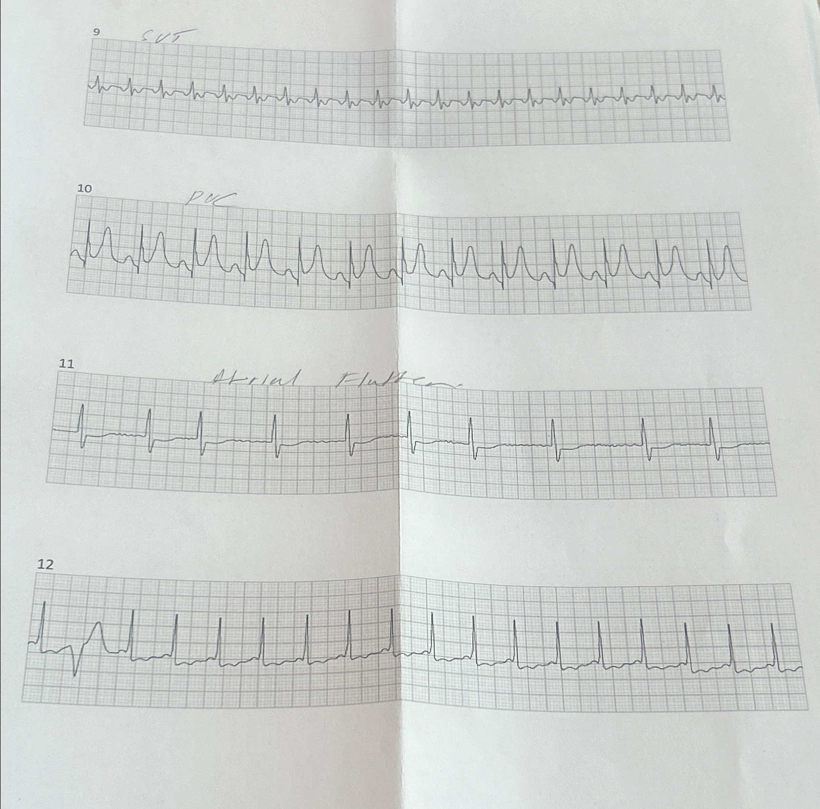 Solved What are the names of the heart rhythm on each | Chegg.com
