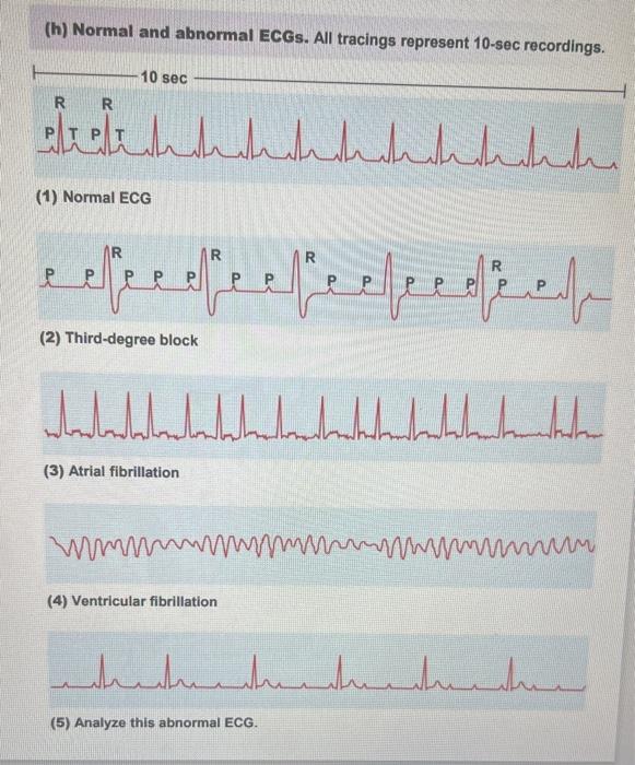(h) Normal and abnormal ECGs. All tracings represent | Chegg.com