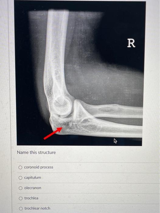Solved R ha Name this structure O coronoid process O | Chegg.com