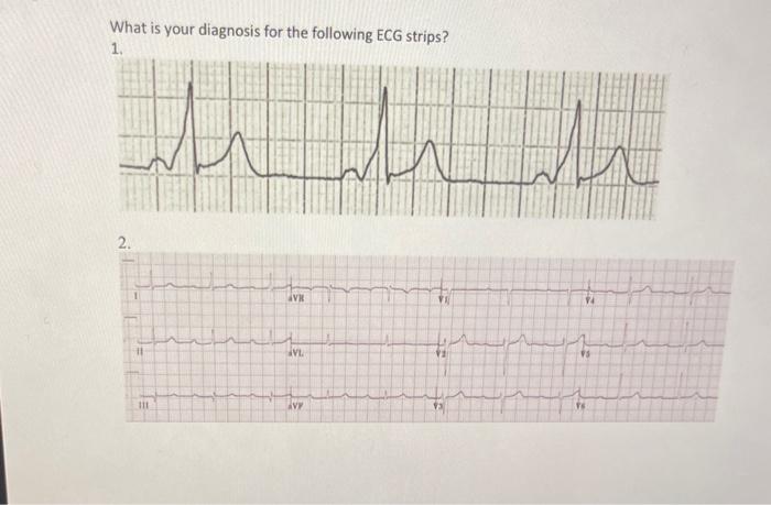 Solved What is your diagnosis for the following ECG strips? | Chegg.com