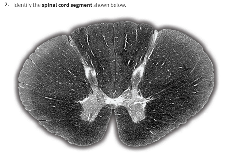 Solved Identify the spinal cord segment shown below.conus | Chegg.com