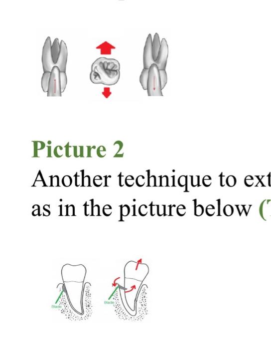 what is the tooth extraction technique called for | Chegg.com