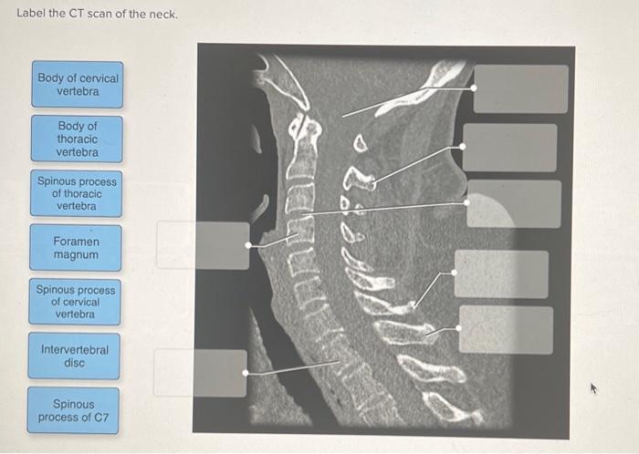 Solved Label the CT scan of the neck. | Chegg.com