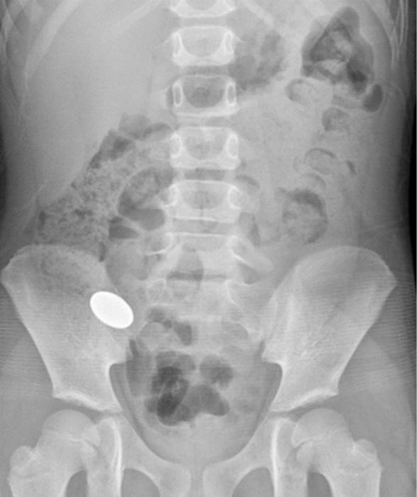 Solved question regarding distortion of radiographic | Chegg.com