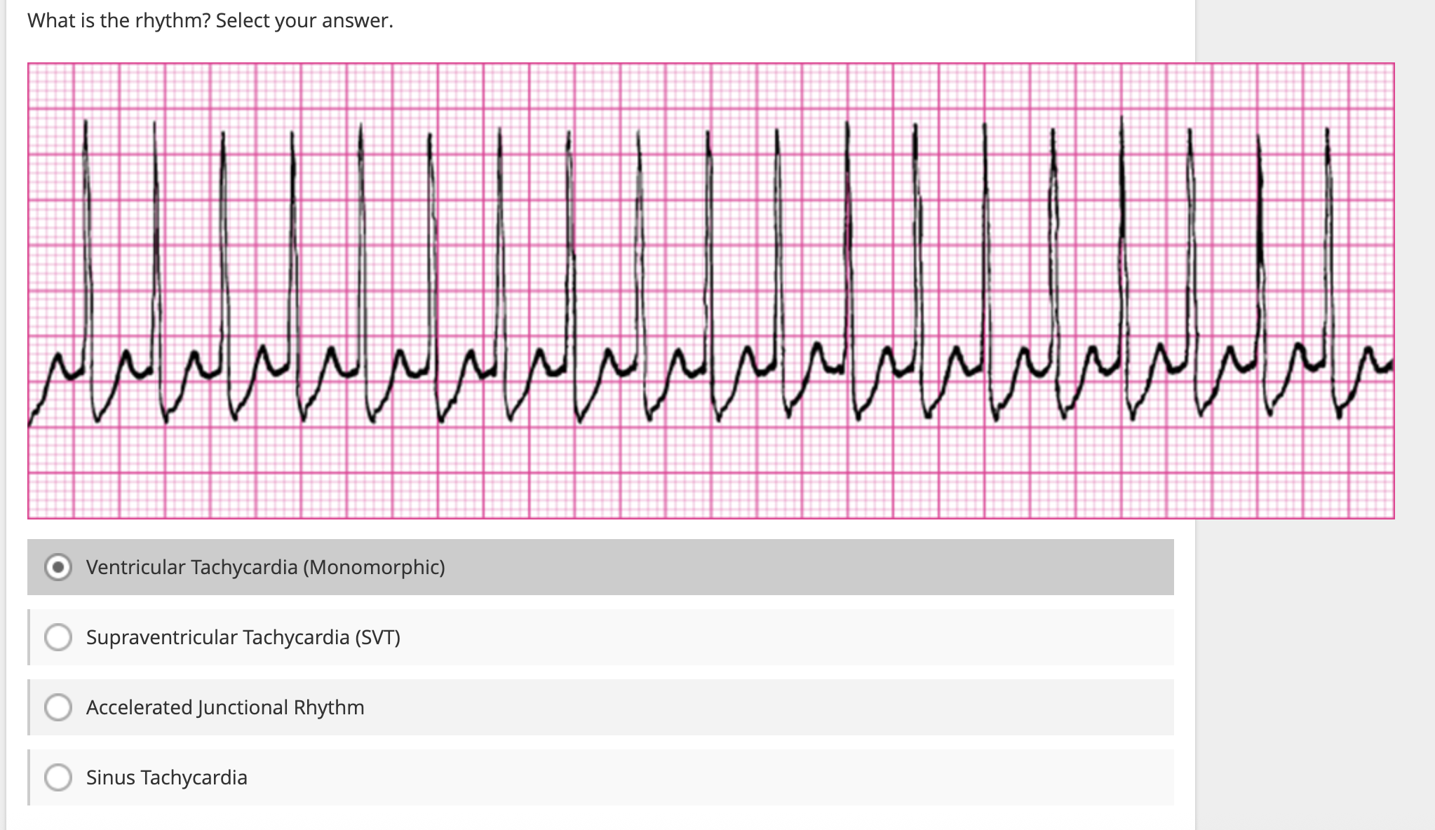 Solved What is the rhythm? ﻿Select your answer. 1. | Chegg.com