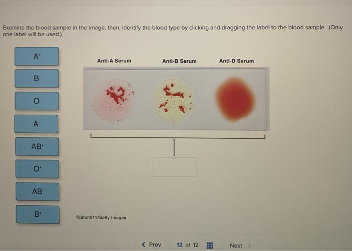Solved Examine the blood sample in the image then, identify | Chegg.com Solved Examine the blood sample in the image then, identify | Chegg.com