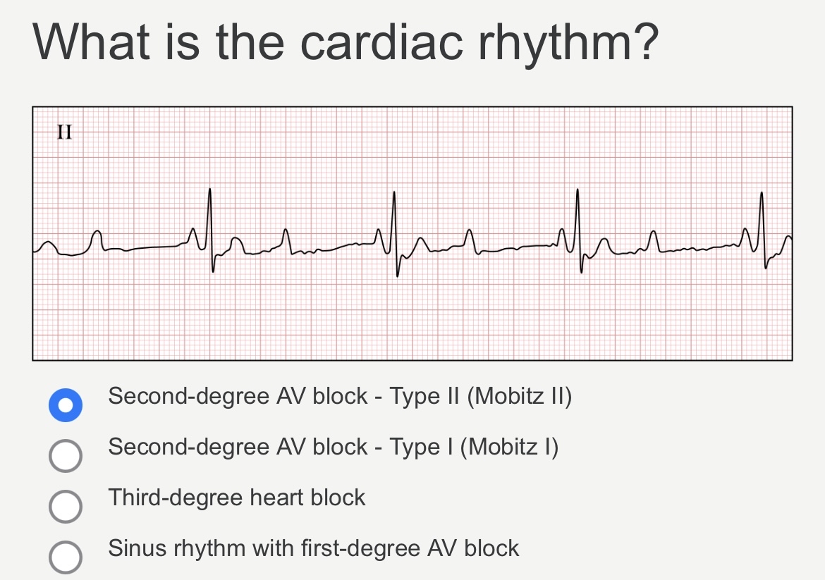 Solved What is the Cardiac Rhythm shown in the EKG Strip | Chegg.com