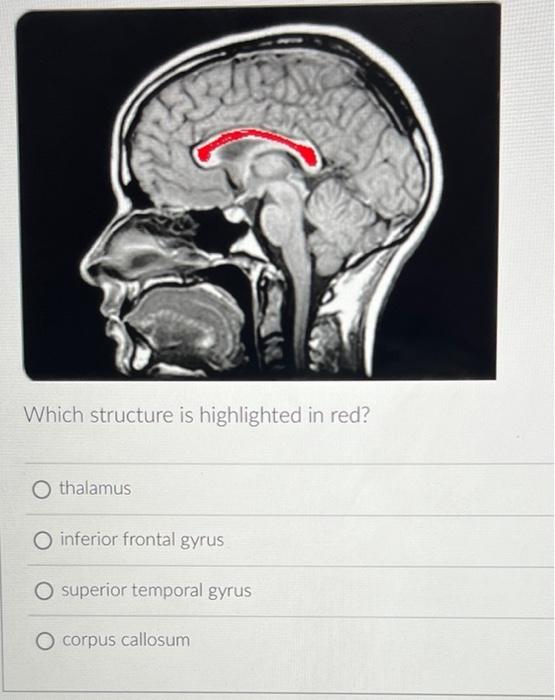 Solved Which structure is highlighted in red? thalamus | Chegg.com