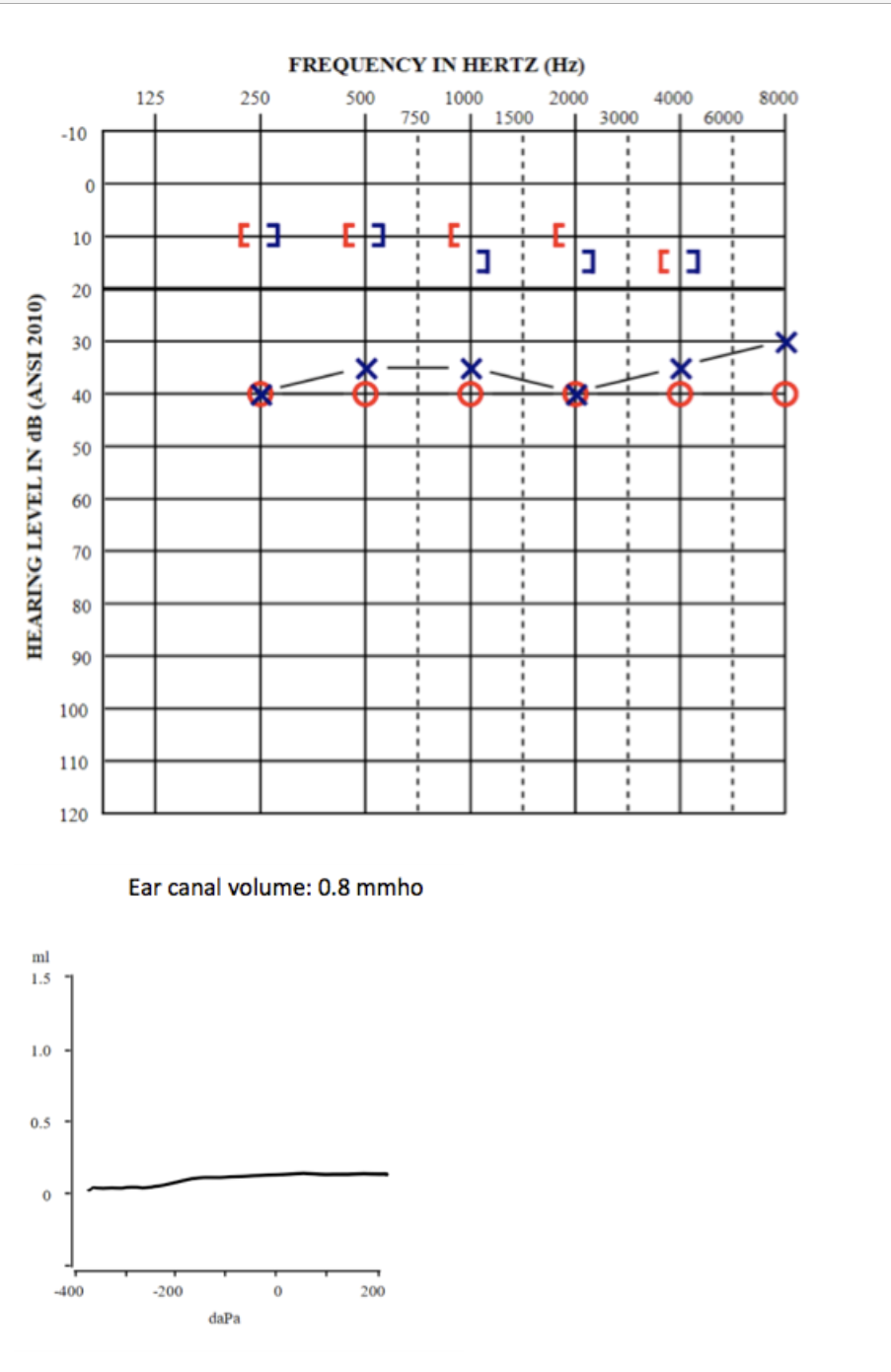 Solved Is This An Expected Tympanogram Based On The Above