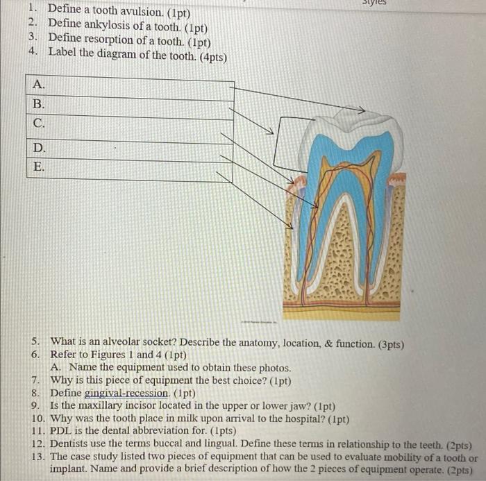 Solved sty es 1. Define a tooth avulsion. (Ipt) 2. Define | Chegg.com