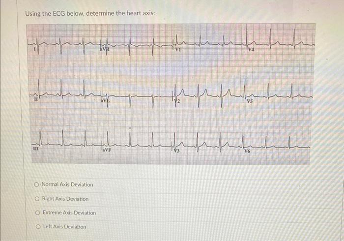 Solved Using the ECG below, determine the heart axis: Normal | Chegg.com