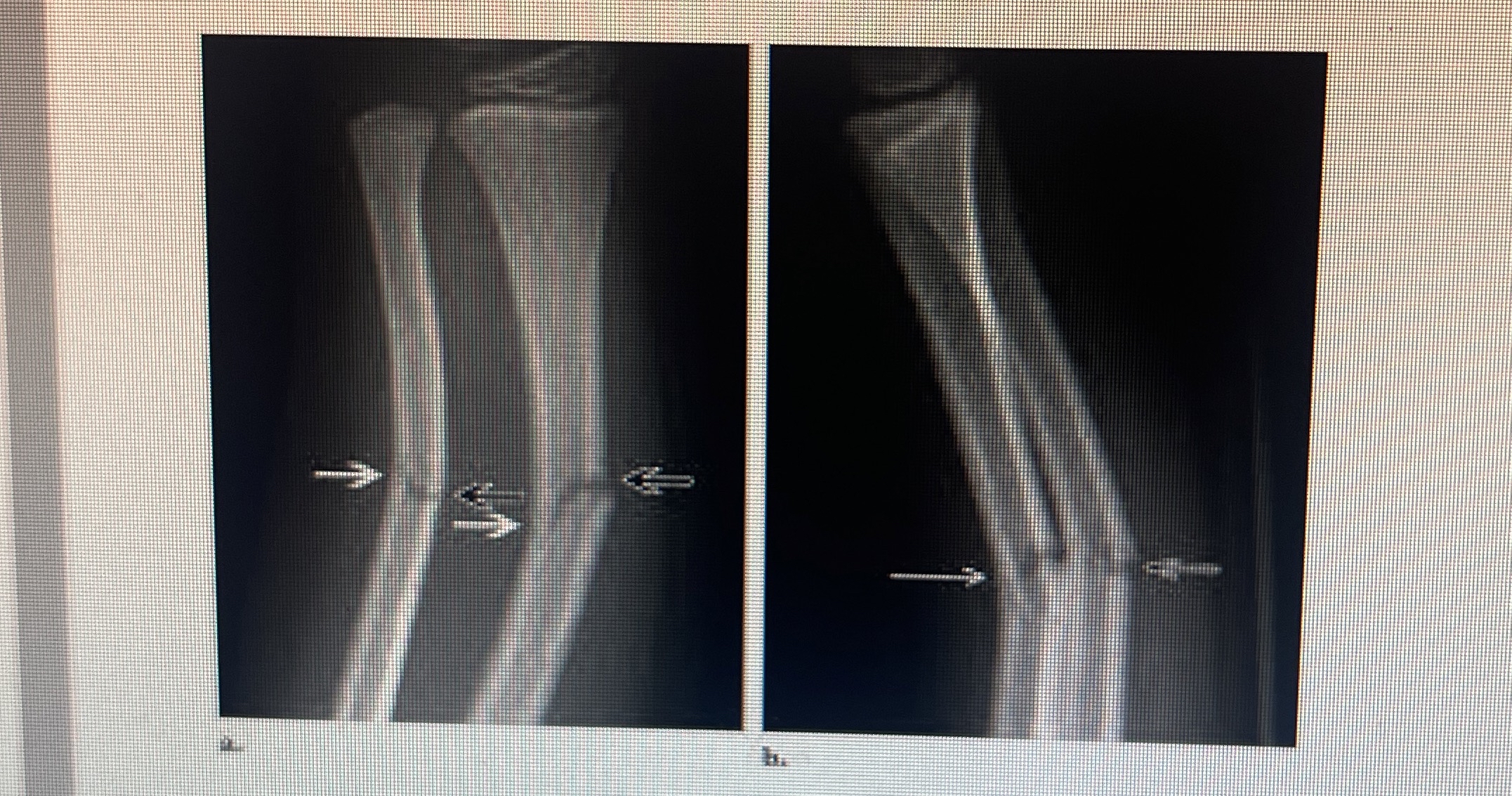 Solved What choice best describes these broken bones? | Chegg.com