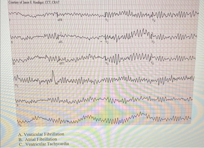 Solved A. Venticular Fibrillation B. Atrial Fibrillation C. | Chegg.com