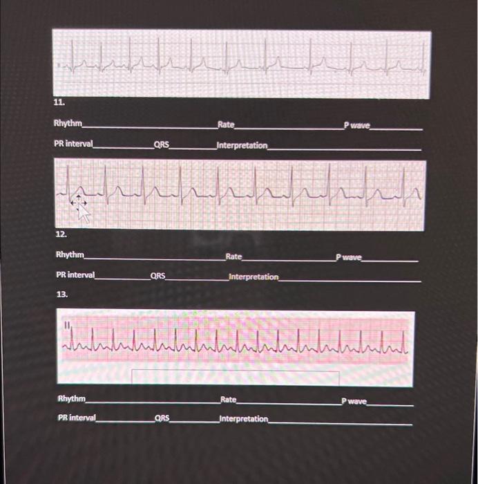 11. Rhythm. Rate P wave PR interval QRS | Chegg.com