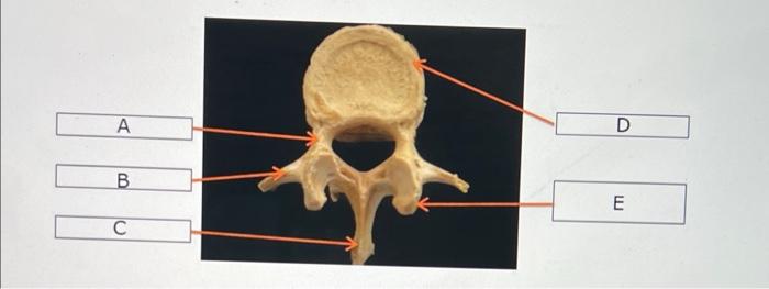 Solved D Body Pedicle Spinous process Superior articular | Chegg.com