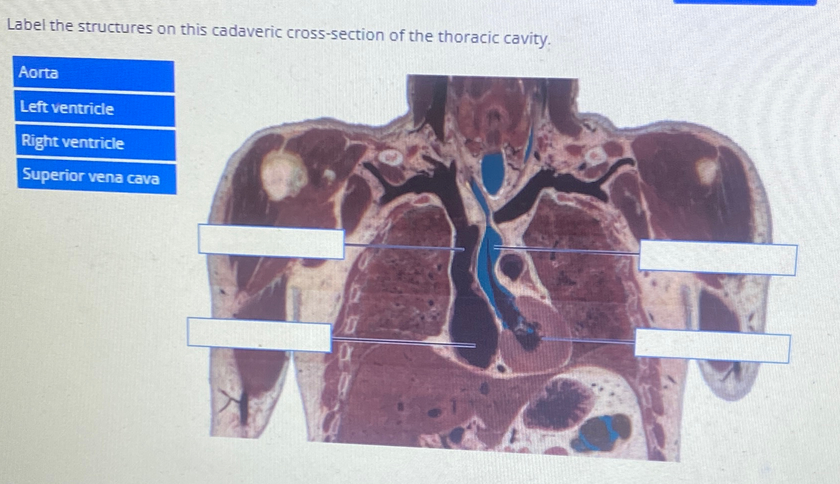 Solved Label the structures on this cadaveric cross-section | Chegg.com