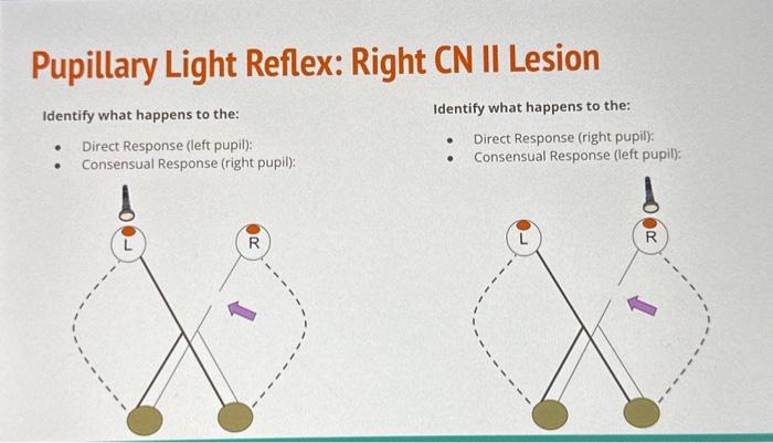 Solved Pupillary Light Reflex: Right CN II Lesion | Chegg.com