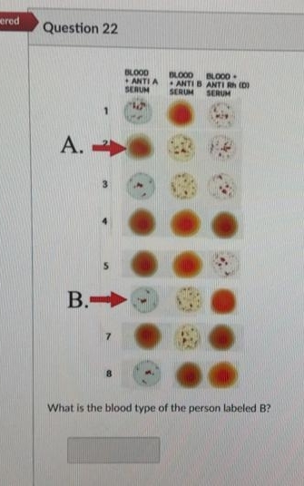 Solved eredQuestion 22What is the blood type of the person | Chegg.com