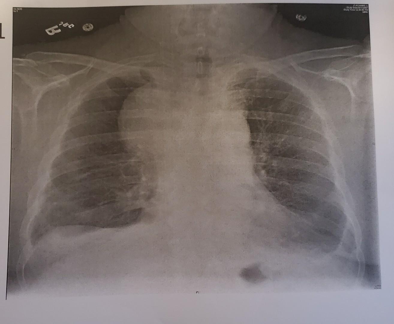 1- ﻿﻿interpret ﻿this ﻿CXR ﻿and ﻿explain ﻿reasoning | Chegg.com