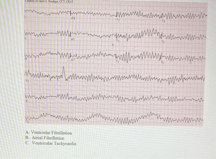 Solved A. Venticular Fibrillation B. Atrial Fibrillation C. | Chegg.com