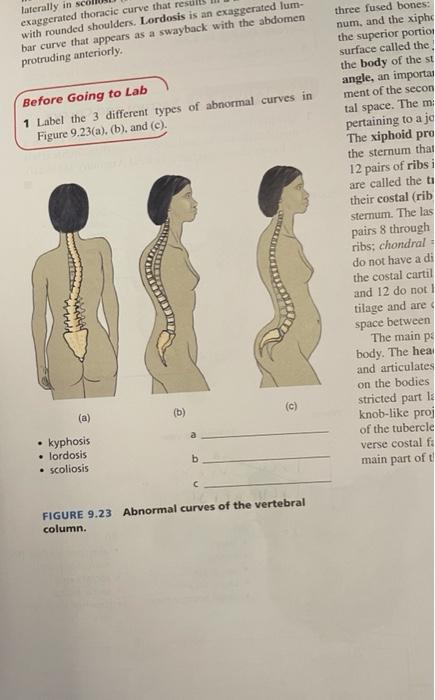 Solved laterally in exaggerated thoracic curve that resu | Chegg.com