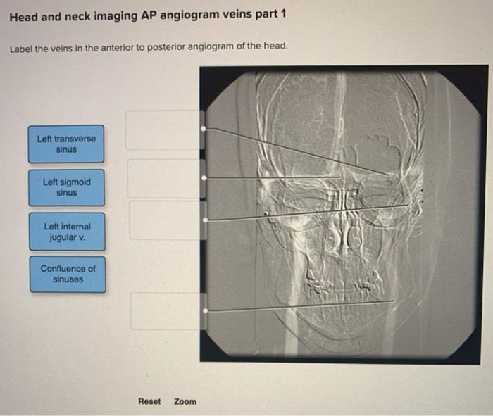 Solved Head And Neck Imaging AP Angiogram Veins Part 1 Label | Chegg.com