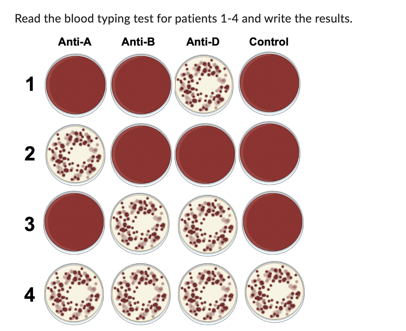 Solved Read the blood typing test for patients 1-4 ﻿and | Chegg.com