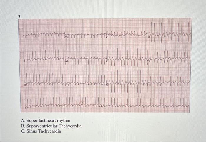 Solved A. Super fast heart rhythm B. Supraventricular | Chegg.com