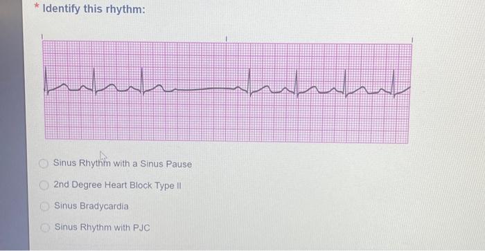 Solved Identify this rhythm: Sinus Rhythm with a Sinus Pause | Chegg.com