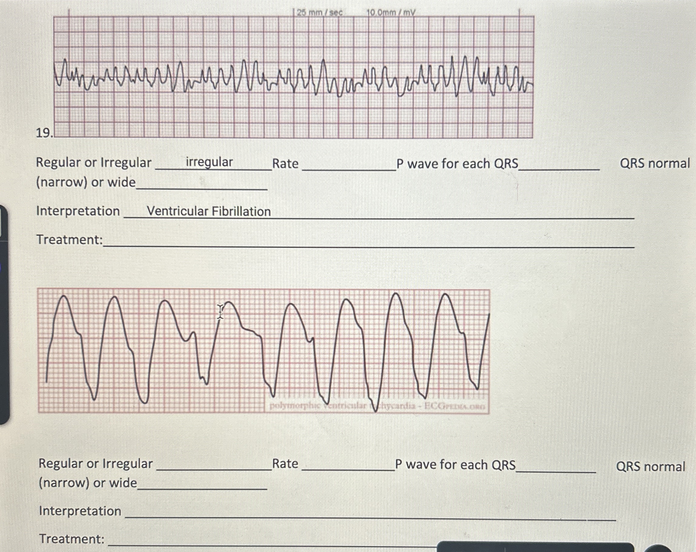 Solved Regular or Irregular q, ﻿irregular Rate ﻿P wave for | Chegg.com