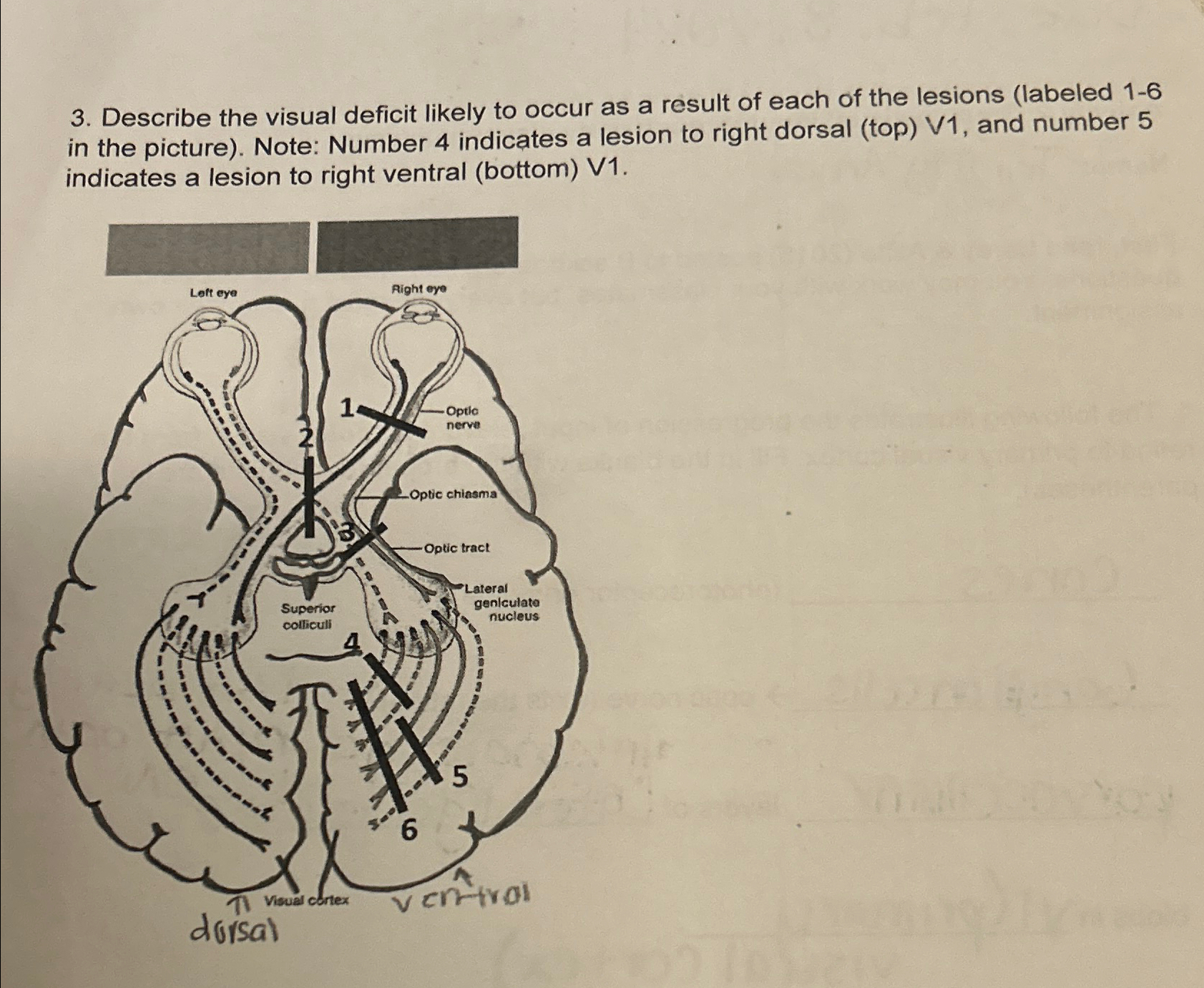 Solved Describe the visual deficit likely to occur as a | Chegg.com