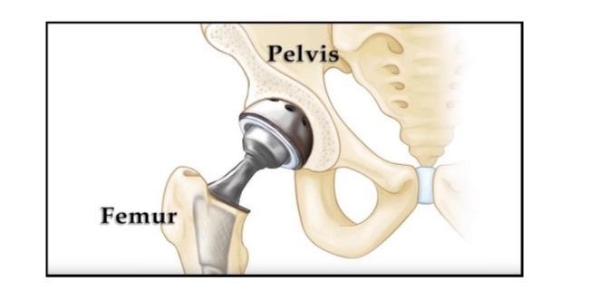 Solved PDS of hip implant product identification special | Chegg.com