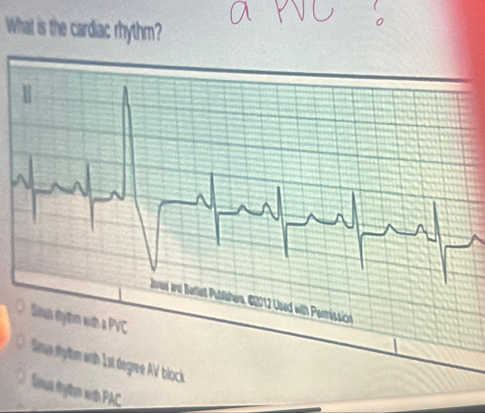 Solved What is this cardiac rhythm? ﻿Sinus rhythm with a PVC | Chegg.com