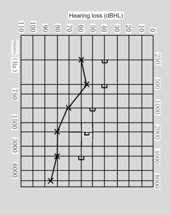 Solved 21. IF the bone conduction threshold is 0 dB HL, the | Chegg.com