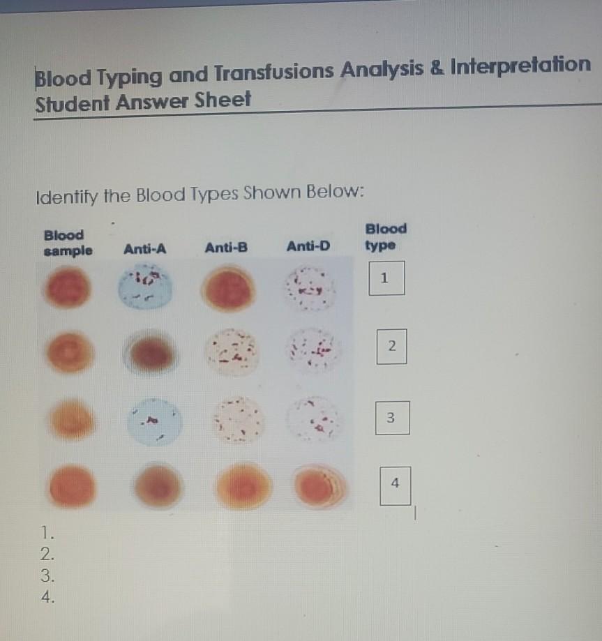 Solved Blood Typing and Transfusions Analysis & | Chegg.com