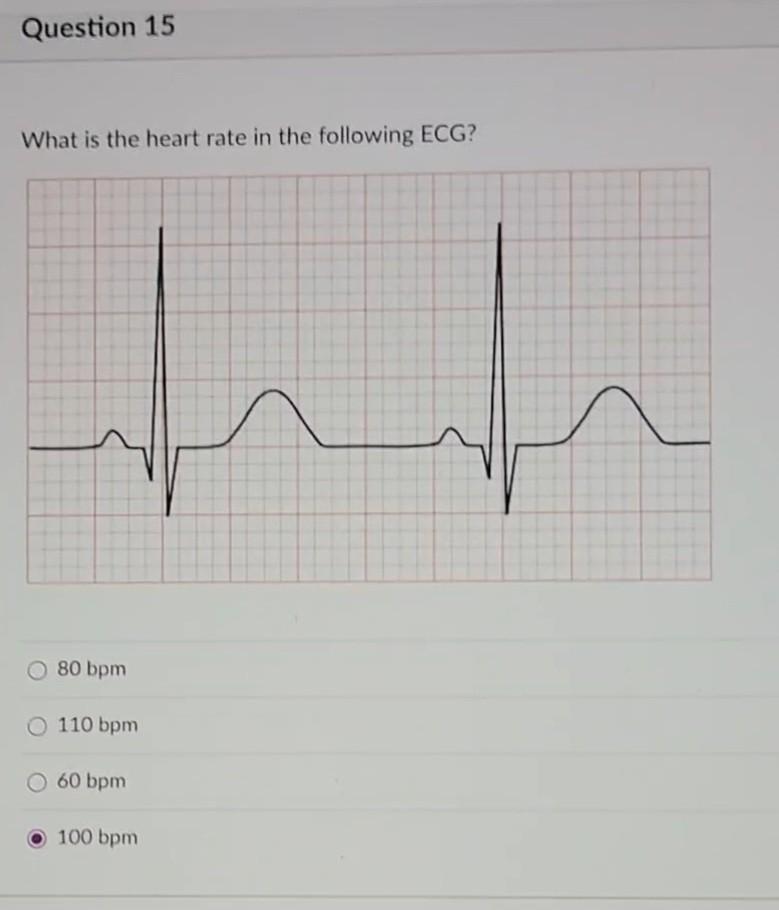 Solved Identify the ECG: heart block ventricular tachycardia | Chegg.com