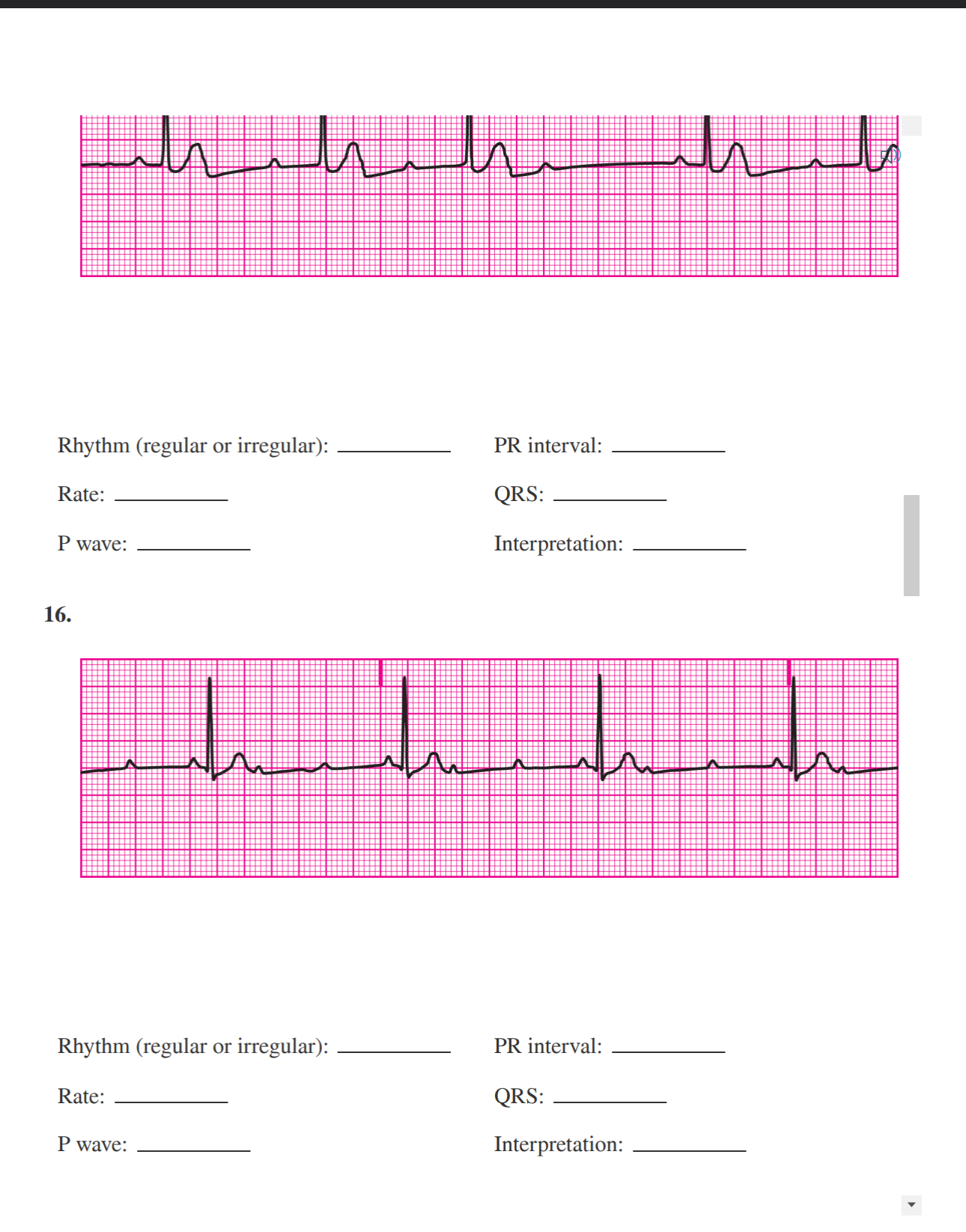 Solved Rhythm (regular or irregular):Rate:P ﻿wave:PR | Chegg.com
