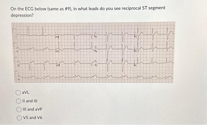 Solved On the ECG below (same as \#9), in what leads do you | Chegg.com