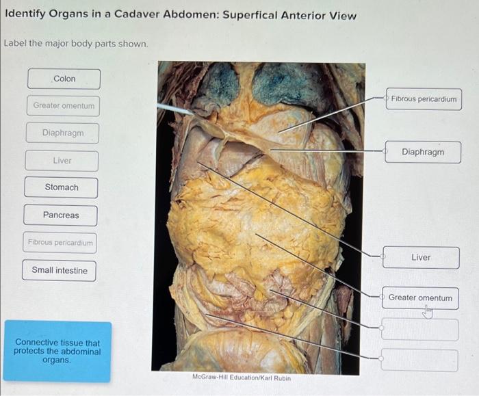 Solved Identify Organs in a Cadaver Abdomen: Superfical | Chegg.com