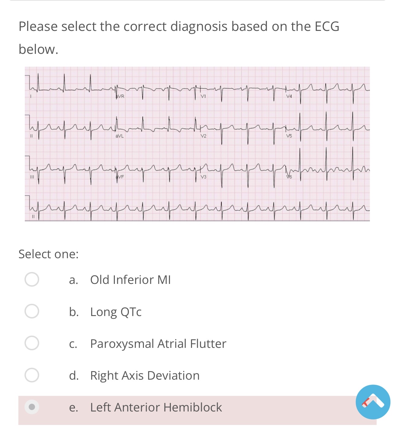 Solved Please select the correct diagnosis based on the ECG | Chegg.com