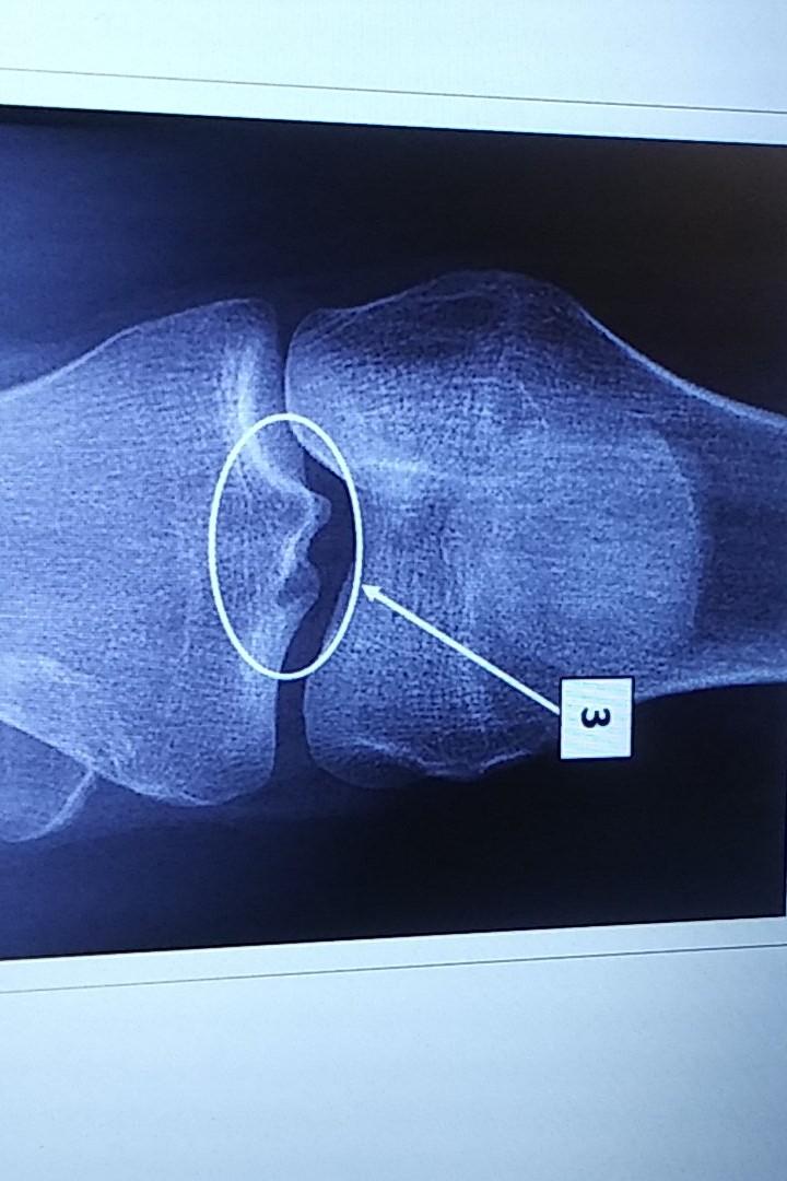 Solved 2 Name the pinned structure Linea.alba Linea aspera | Chegg.com