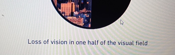 Solved Loss of vision in one half of the visual field | Chegg.com
