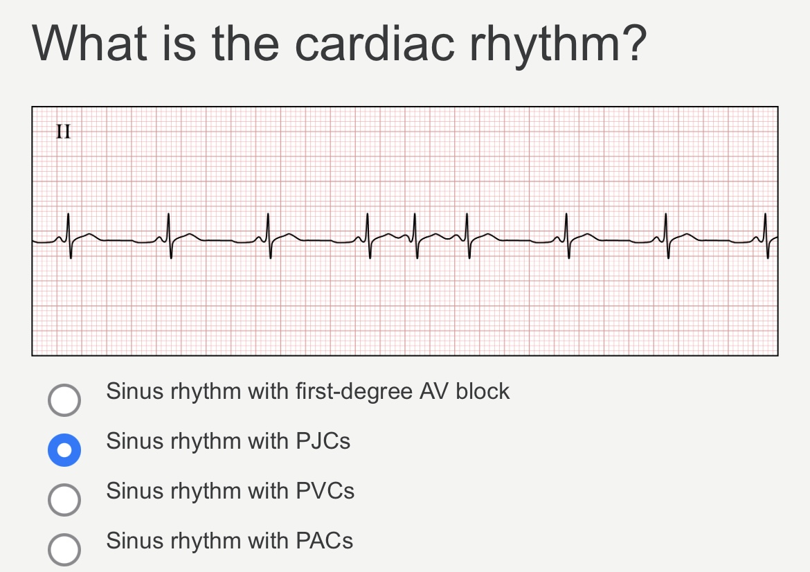 Solved Of the multiple choice options provided below the EKG | Chegg.com