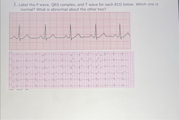 label waves on each ECG please and state which is | Chegg.com