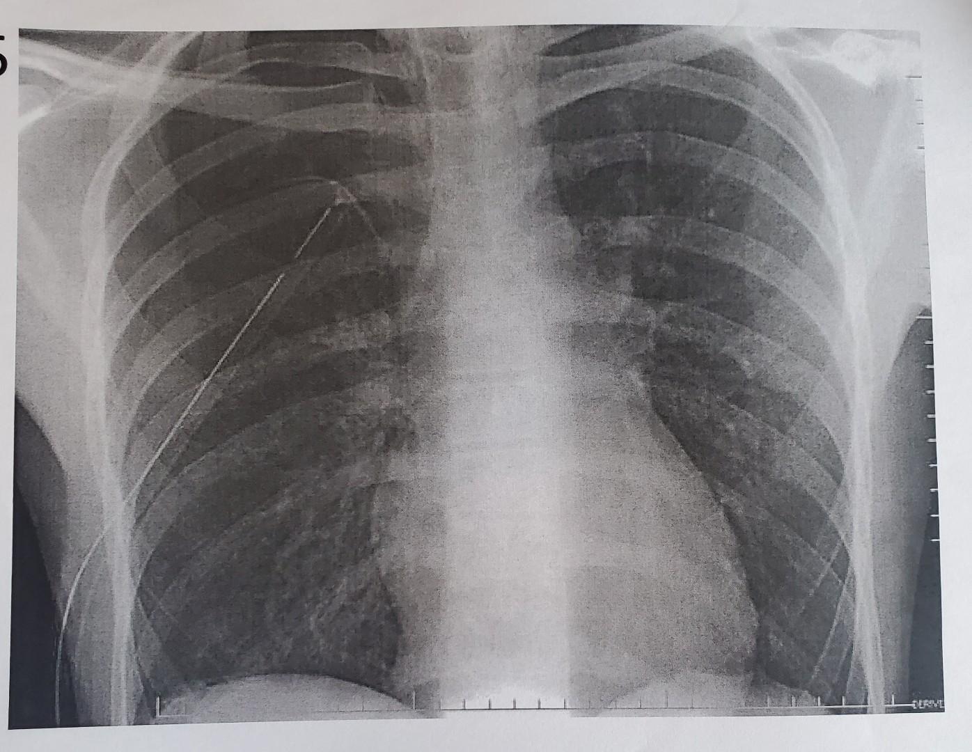 15- ﻿interpret this CXR and explain reasoning behind | Chegg.com