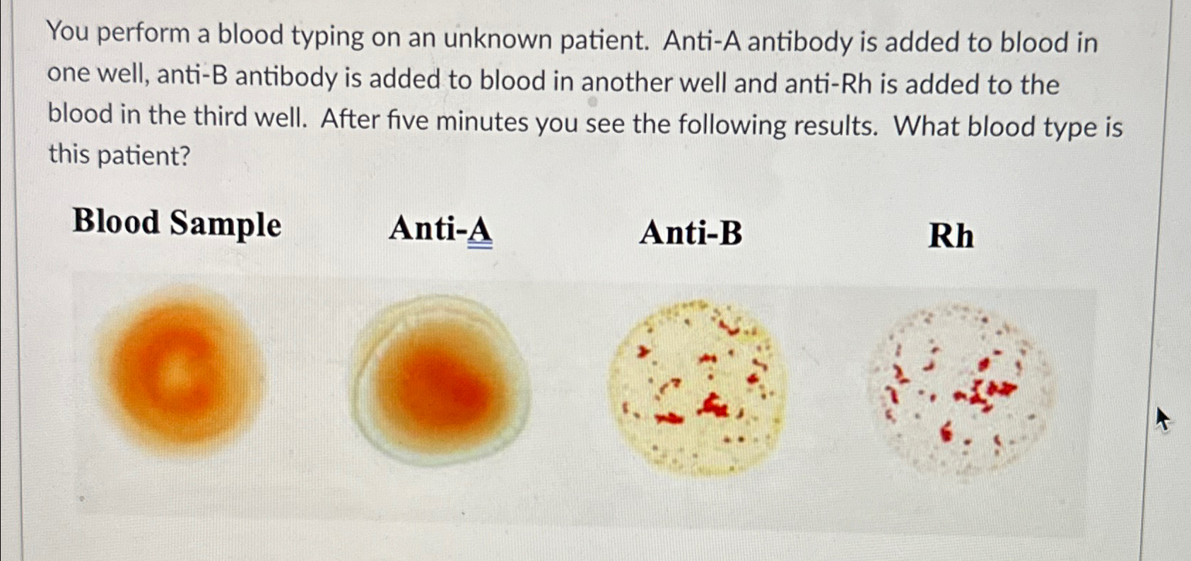 Solved You perform a blood typing on an unknown patient. | Chegg.com | Chegg.com
