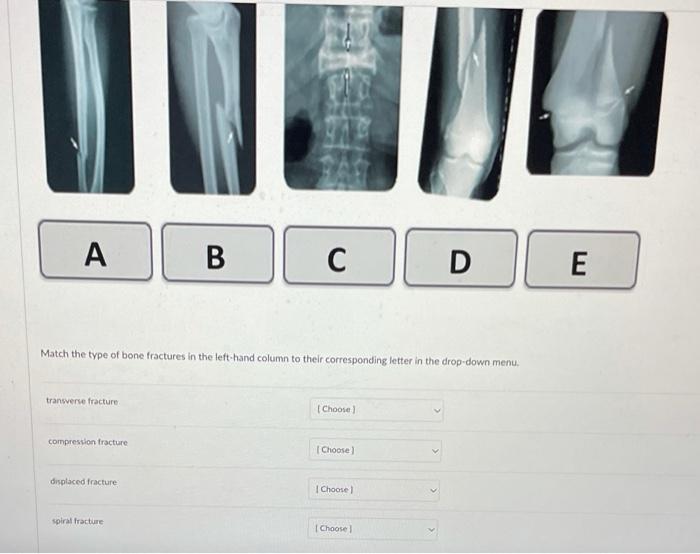 Solved Match the type of bone fractures in the left-hand | Chegg.com