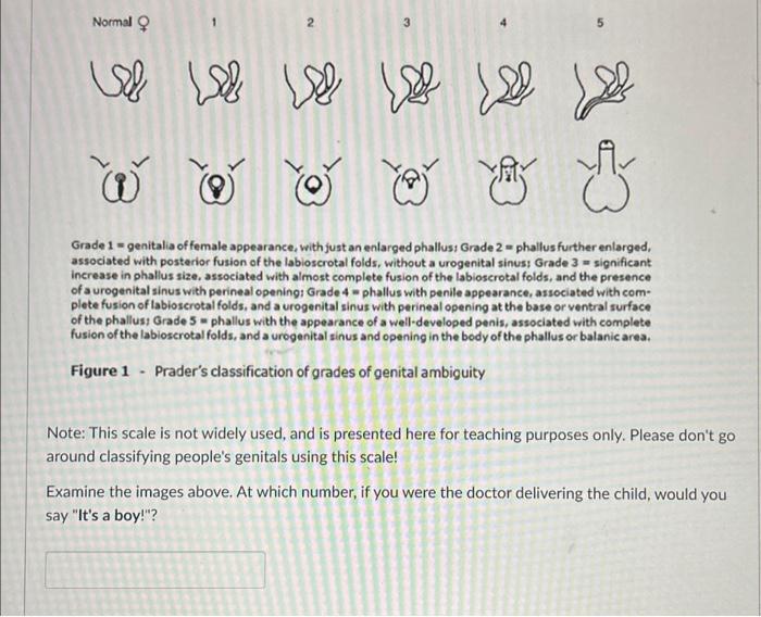 Normal ? 2 Grade 1 = genitalia of female appearance, | Chegg.com
