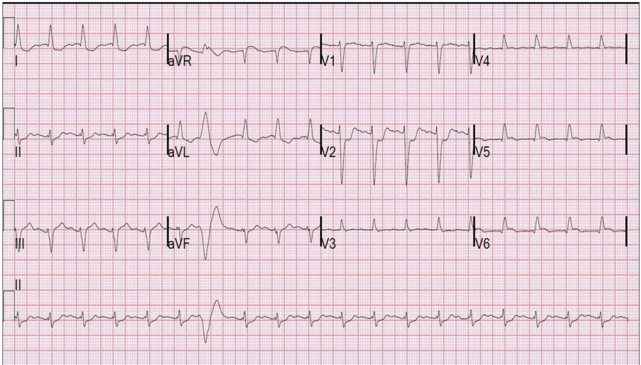 Solved by an EXPERT What are the rate, rhythm, ﻿axis, rotation, | Chegg.com